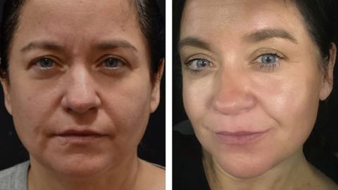 Hollywood Facial services in Washington D.C & DMV area