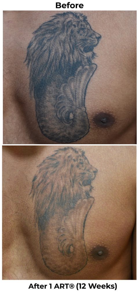 Before and After Tattoo Removal Results in DMV Area